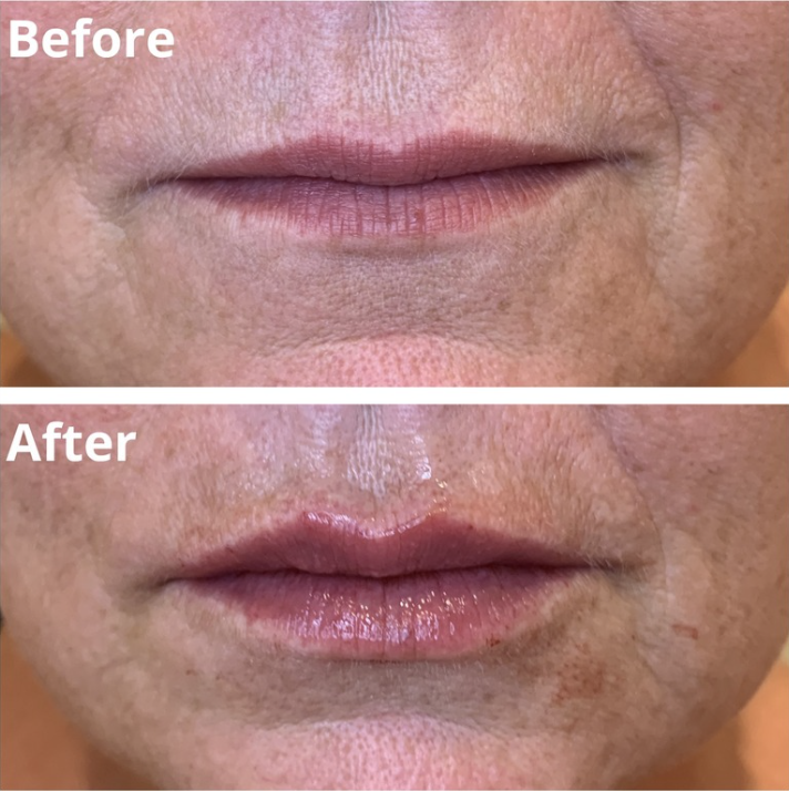 Lip Filler at Doghurst Clinic | Subtle, Doctor-Led Care